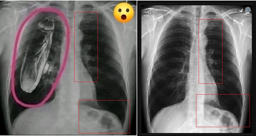 New version of old cockroach X-ray hoax circulates in Nigeria and Kenya ...