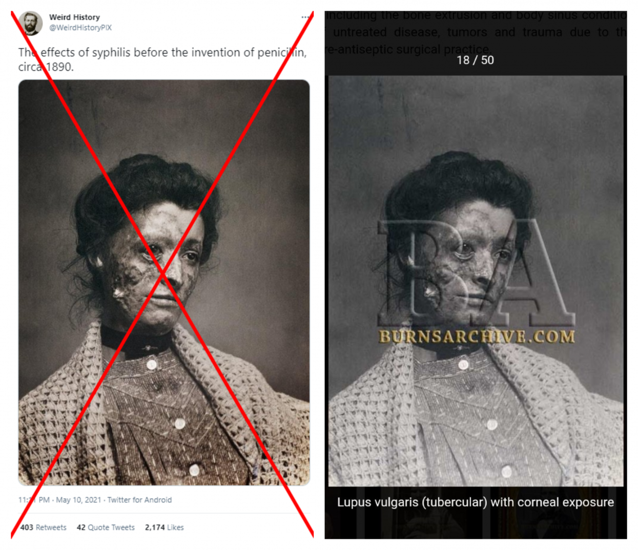 This photo shows a woman with tuberculosis of the skin in 1895, US ...