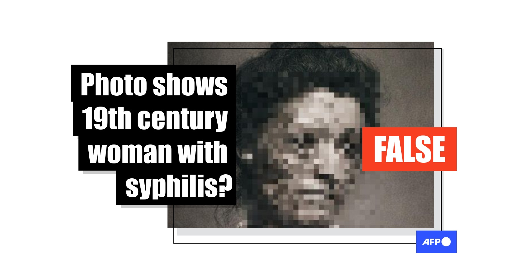 This photo shows a woman with tuberculosis of the skin in 1895, US ...